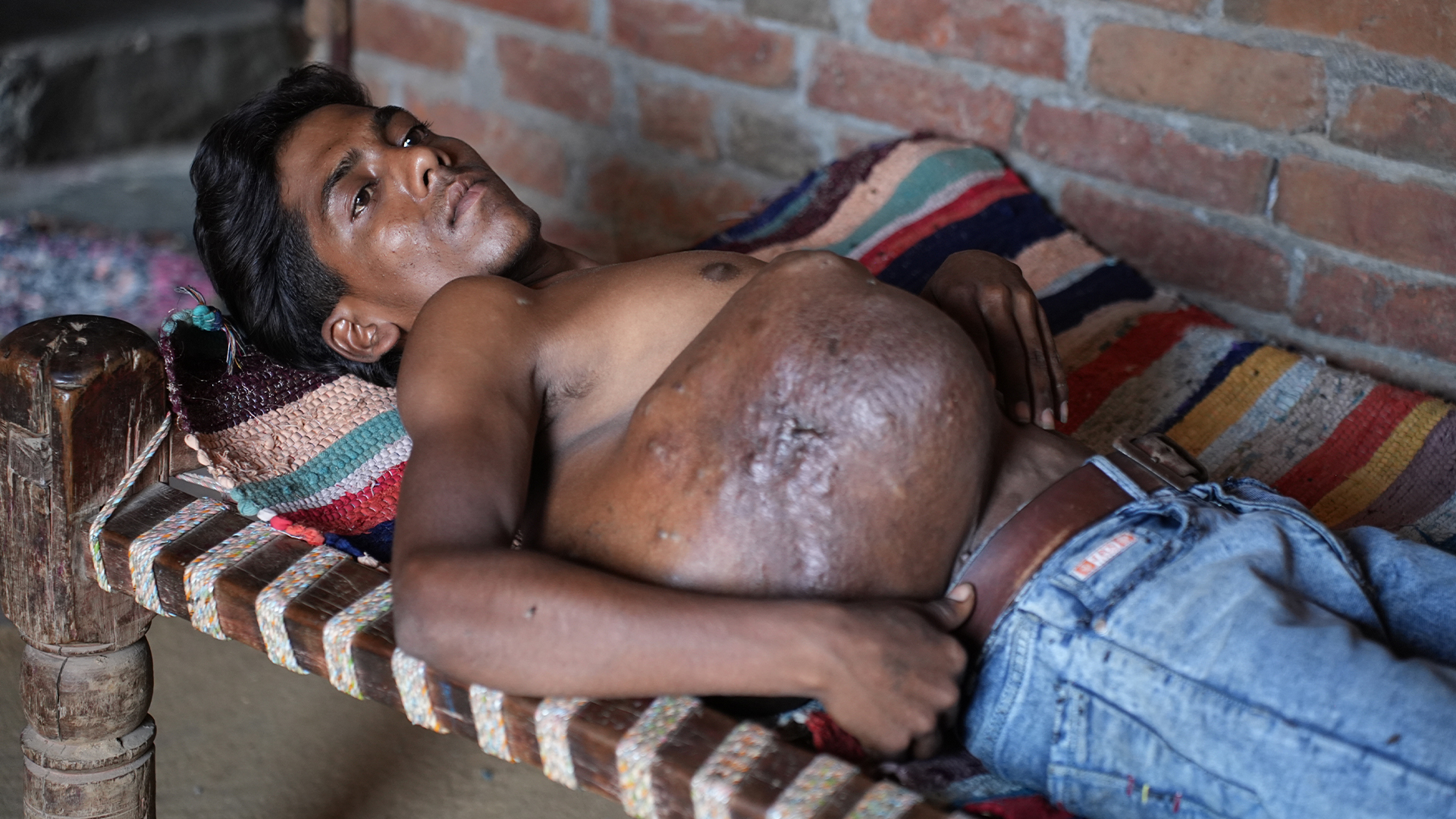 A Massive Tumour Has Left This 23-Year-Old Yearning For A Normal Life ...